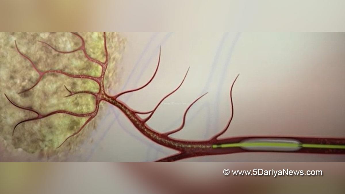 New minimally invasive therapy shows promise for liver cancer patients